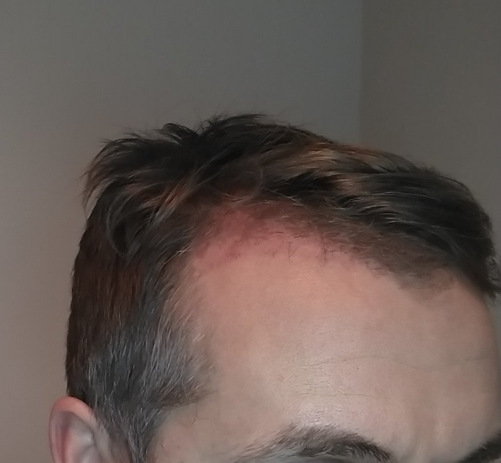 Recent Transplant - Unnatural Hairline - Temporal Angles | Page 2 ...