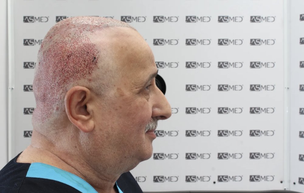 Asmed Clinic - FUE - 4558 Grafts - 12 Month Result. | Hair loss Forum - Hair Transplant forums