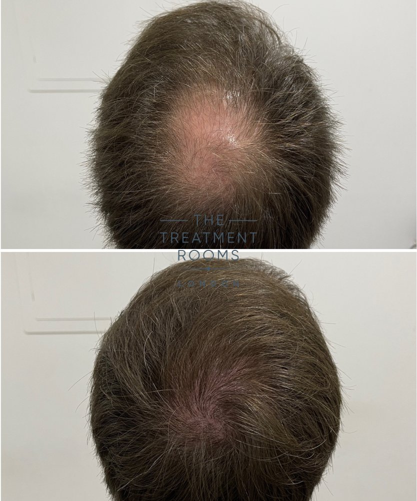 Crown Hair Transplant 1485 grafts- The Treatment Rooms London