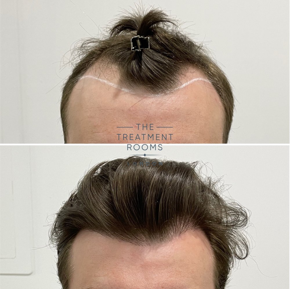 1357 Grafts Hairline & Temple Restoration
