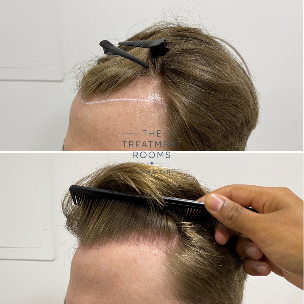 1700 Grafts Hairline FUE Hair Transplant