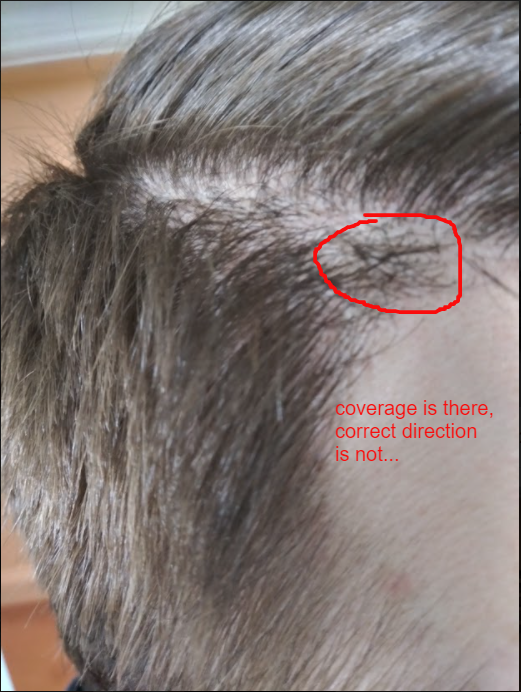Super Nervous About Upcoming Repair Surgery | Hair loss Forum - Hair ...