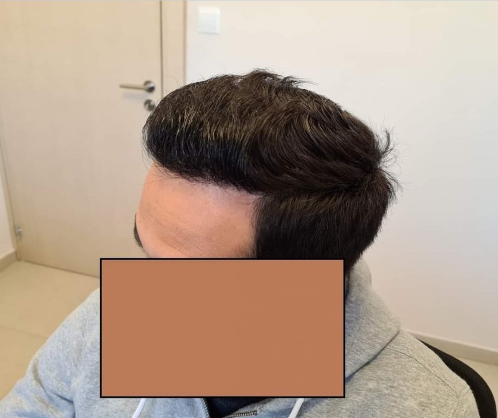 HDC clinic in Cyprus, Dr. Christina FUE 3204 grafts for NW4 | Hair loss ...