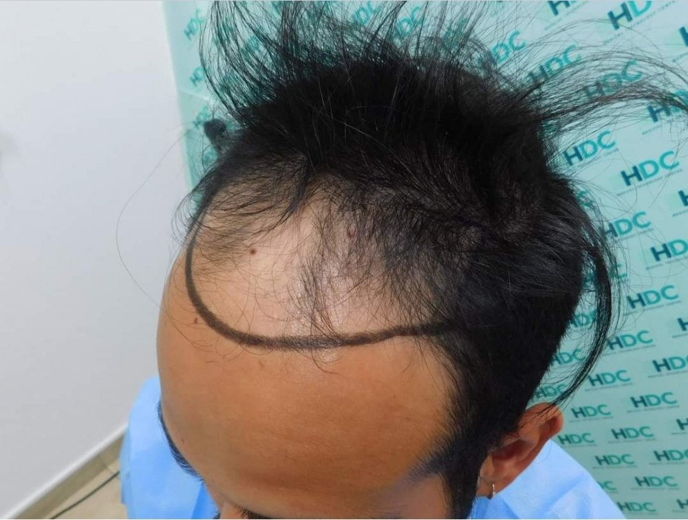 HDC clinic in Cyprus, Dr. Christina FUE 3204 grafts for NW4 | Hair loss ...