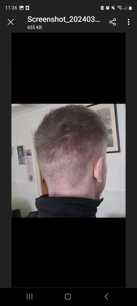 Month 8 finasteride (crown looks worse) | Hair loss Forum - Hair ...