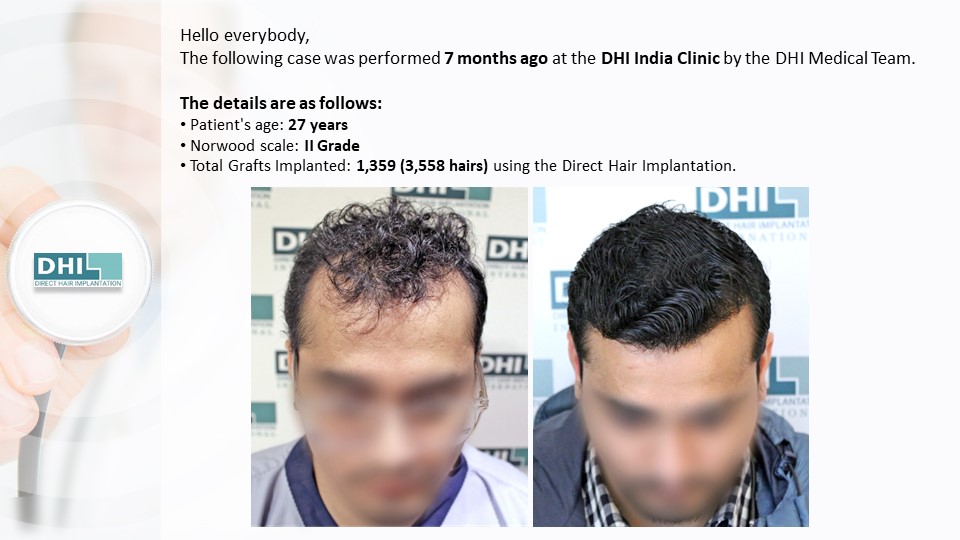 DHI India | NW 2 | 1,359 Grafts | 7-Months DHI Hair Transplant Results ...