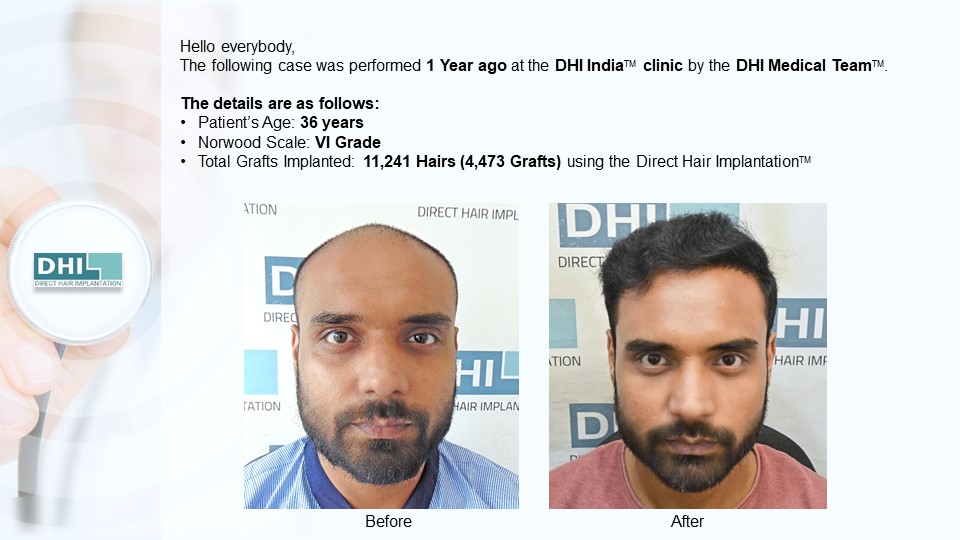 DHI India™ | NW 6 | 4,473 Grafts | 1-Year Hair Transplant Result | Hair ...