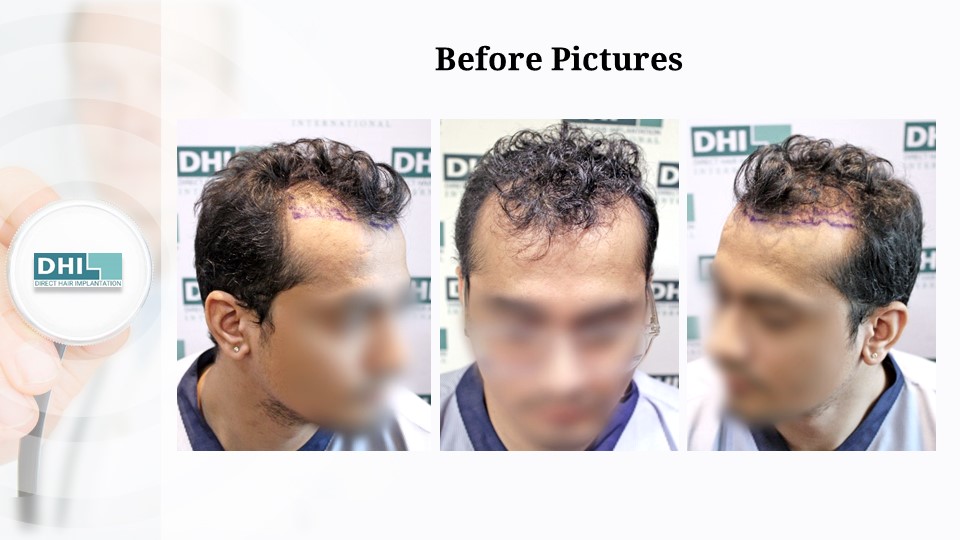 DHI India | NW 2 | 1,359 Grafts | 7-Months DHI Hair Transplant Results ...