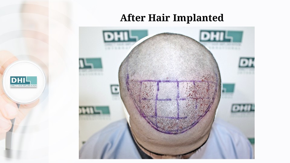 DHI India | NW 2 | 1,359 Grafts | 7-Months DHI Hair Transplant Results ...