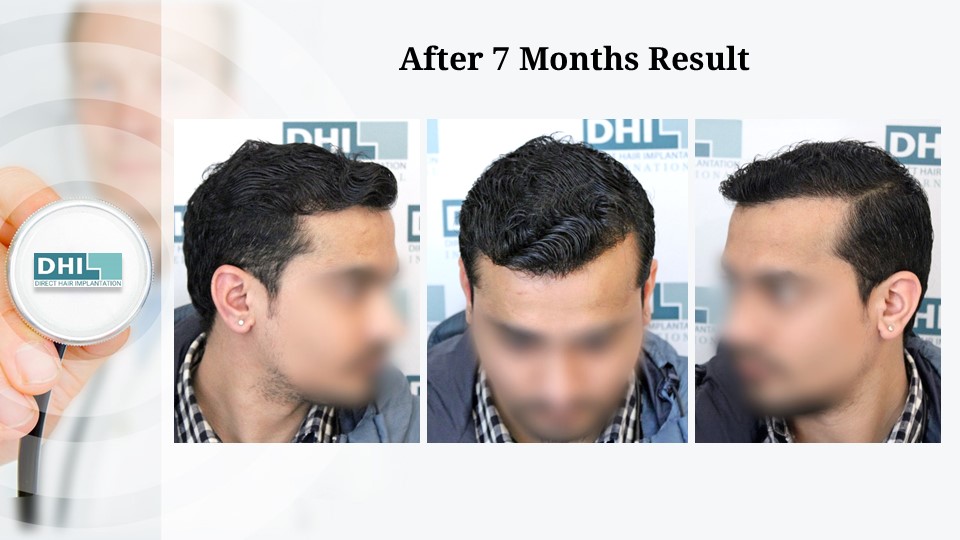 DHI India | NW 2 | 1,359 Grafts | 7-Months DHI Hair Transplant Results ...