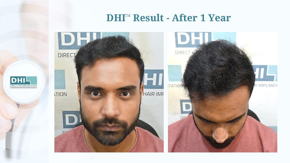 DHI India™ | NW 6 | 4,473 Grafts | 1-Year Hair Transplant Result | Hair ...