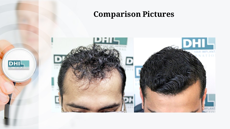 DHI India | NW 2 | 1,359 Grafts | 7-Months DHI Hair Transplant Results ...