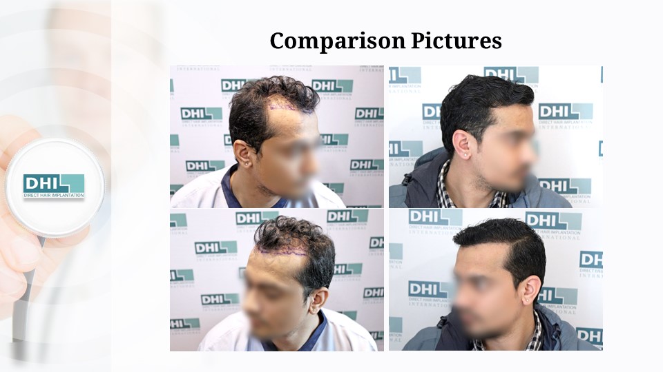 DHI India | NW 2 | 1,359 Grafts | 7-Months DHI Hair Transplant Results ...