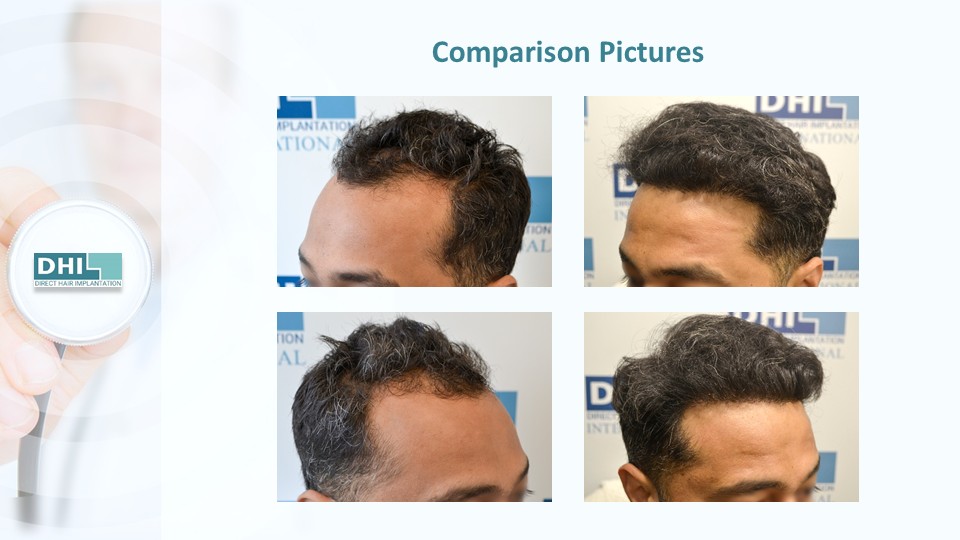 DHI India | NW 3 | 2,055 Grafts | 8 Months DHI Hair Transplant Results ...