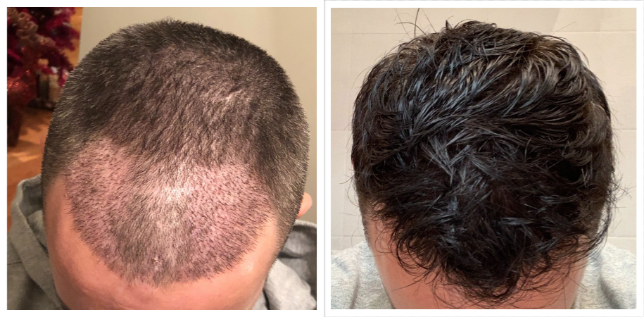 Hair transplant clinic Rubenhair Latvia with ISHRS surgeon | Hair loss ...