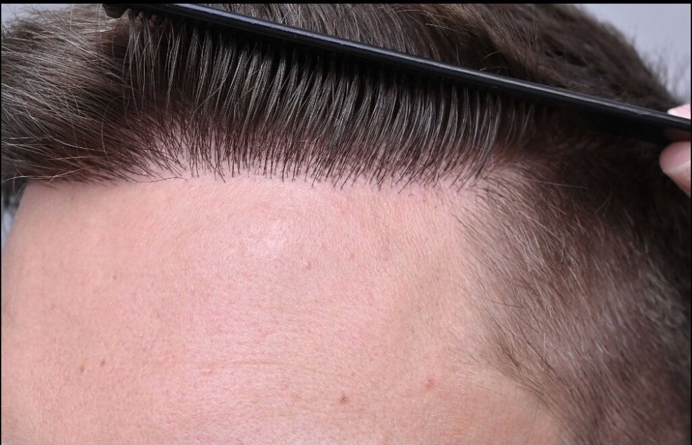 Unnatural Hairline - Repaired by Dr Cooley | Hair loss Forum - Hair ...