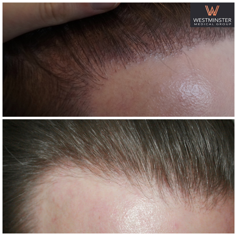 Westminster Medical Group - Hairline Softening Procedure - 654 Single ...