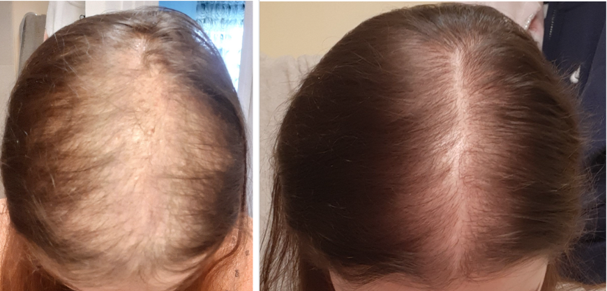 Hair transplant clinic Rubenhair Latvia with ISHRS surgeon | Hair loss ...