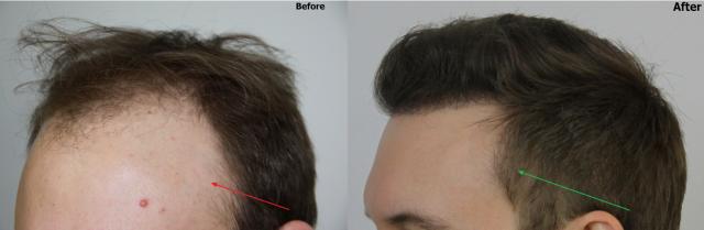 The importance of temple points in hair restoration | Hair loss Forum ...
