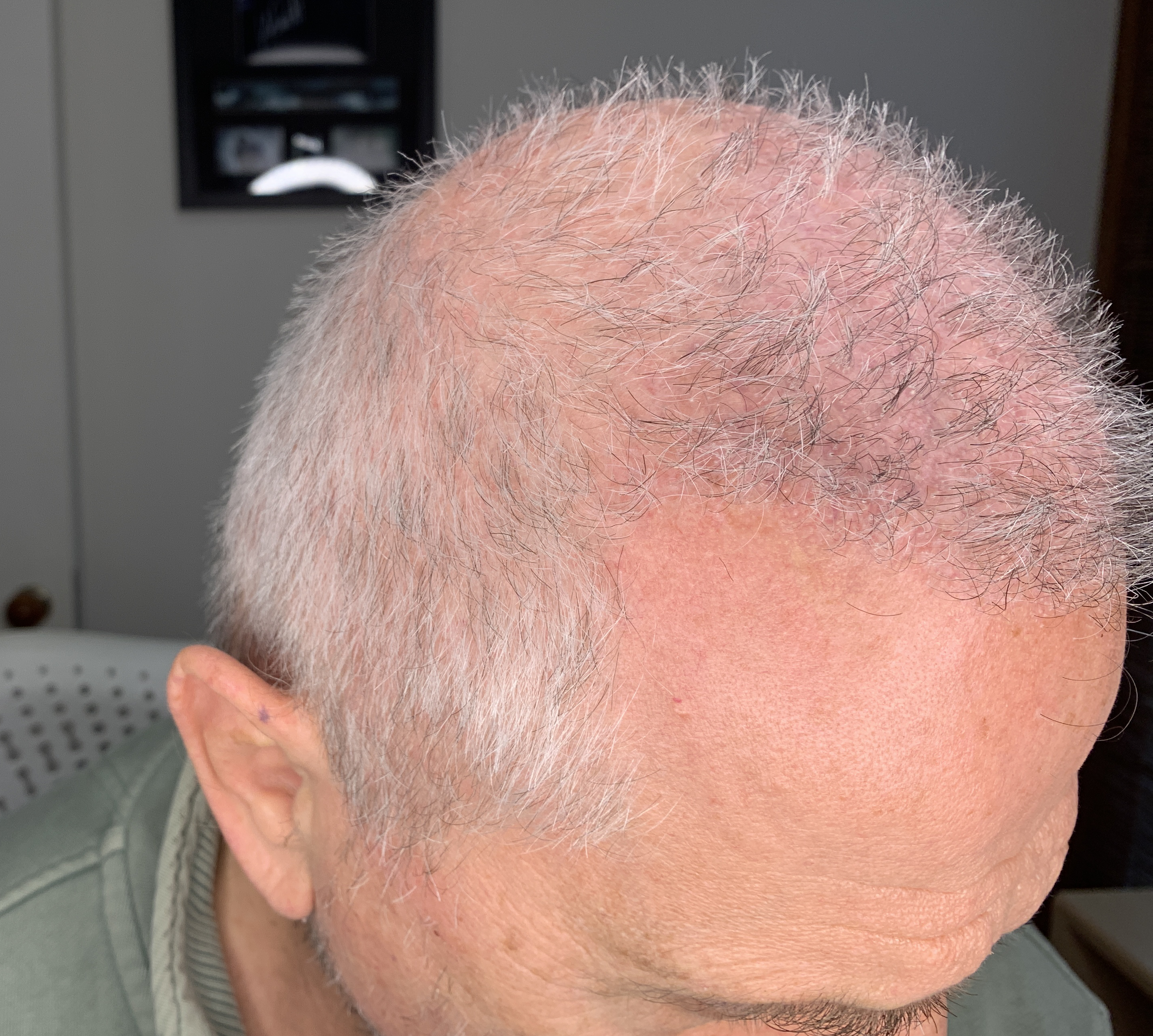 Front Side_Right Tilt Down.jpg | Hair loss Forum - Hair Transplant forums